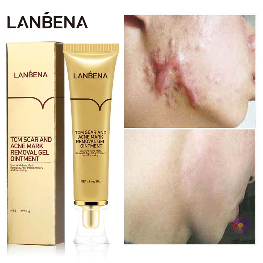 Acne Scar Removal Cream Treatment Acne Stretch Marks Repair Gel Body